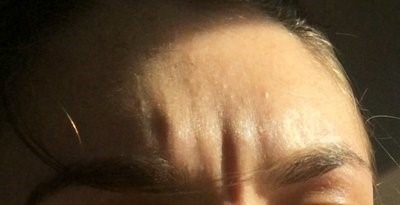 Fix Furrows for a Smoother, Youthful Forehead